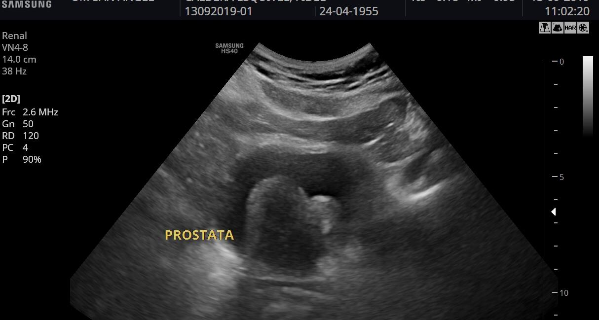Próstata em Foco: A Importância do Ultrassom na Avaliação Prostática ...
